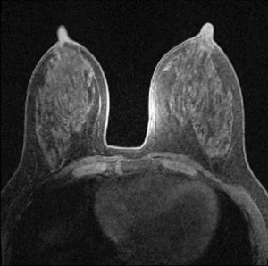 Abbreviated Screening Breast MRI - Triad Radiology Associates