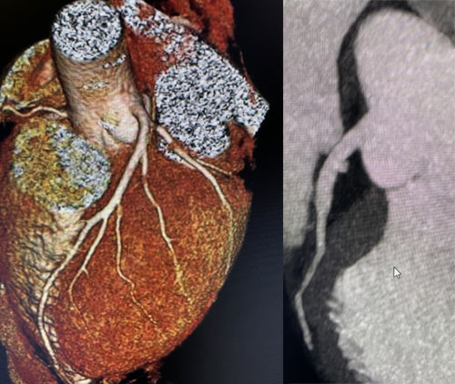 CT Angiography of the Heart (CTA Coronary) - Triad Radiology Associates